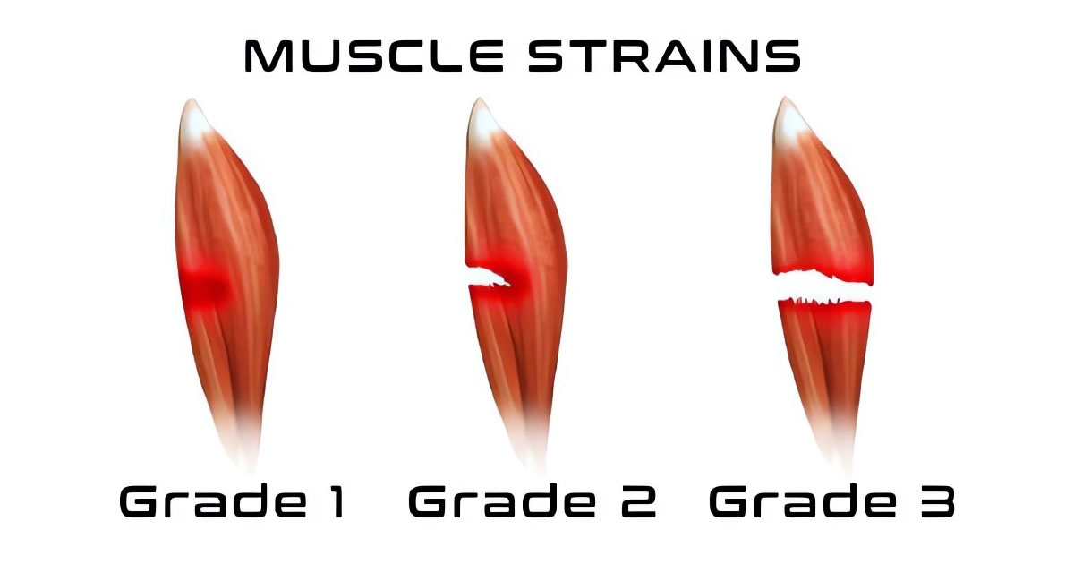 Muscle Tears Strains Muscle Tears Strains